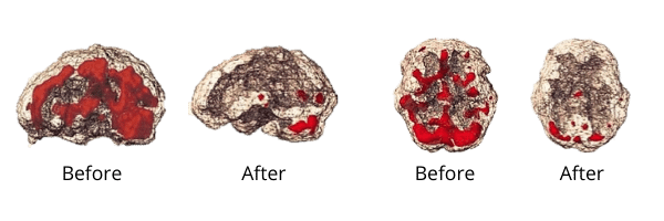 EMDR Online Treatment | Virtual EMDR